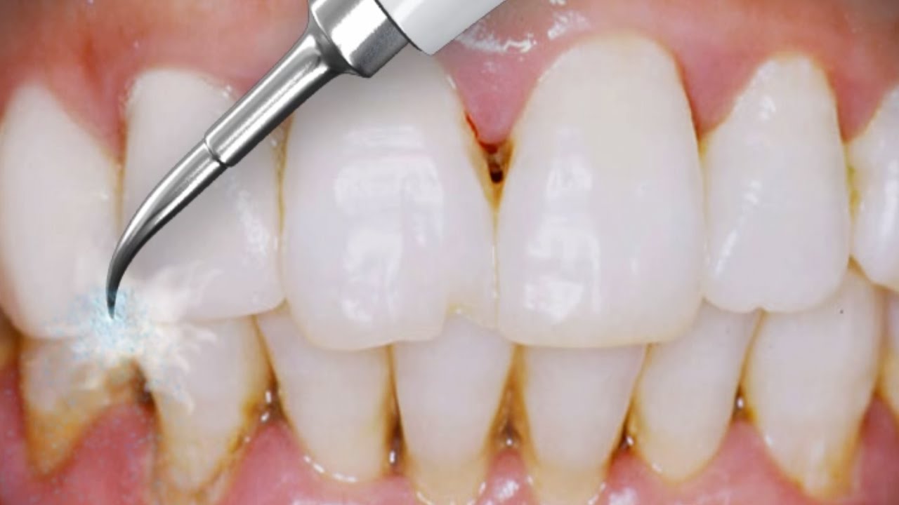 3 Benefits Of Scaling You Didn t Know About DH Dental Clinic Lahore