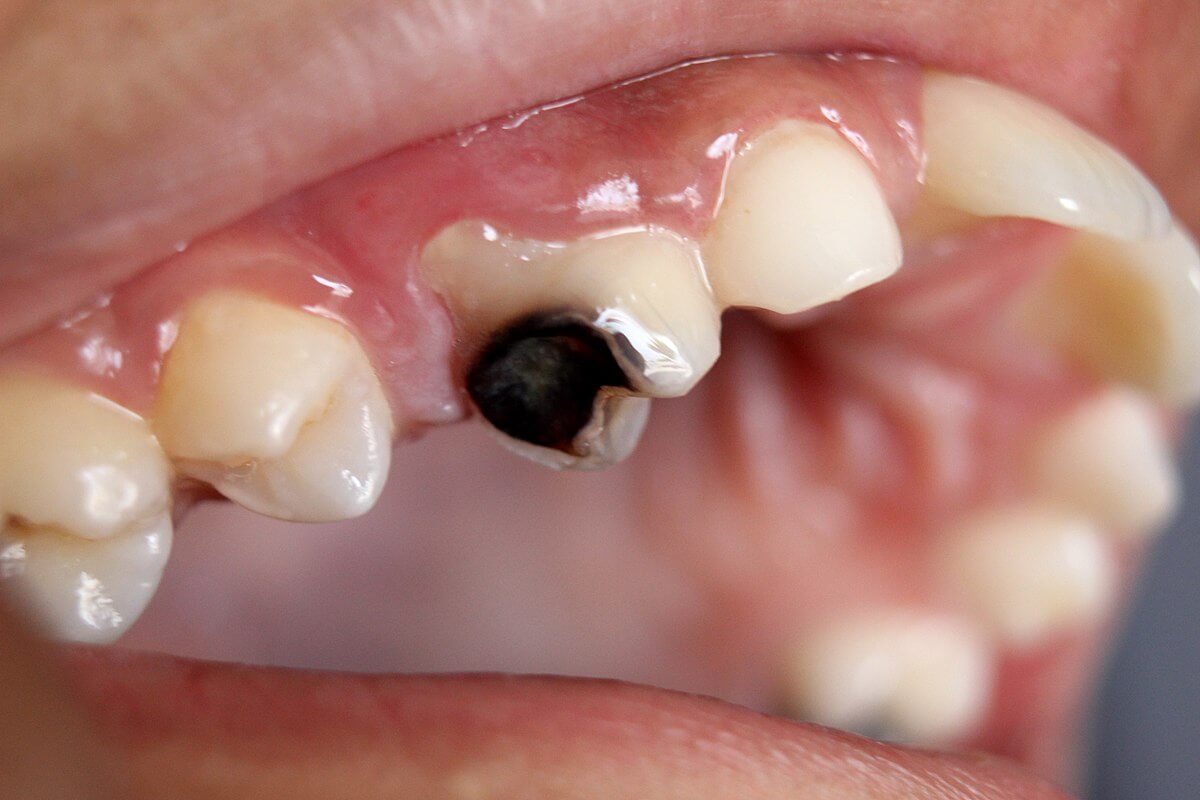 What Happens If I Leave A Cavity Untreated DH Dental Clinic Lahore